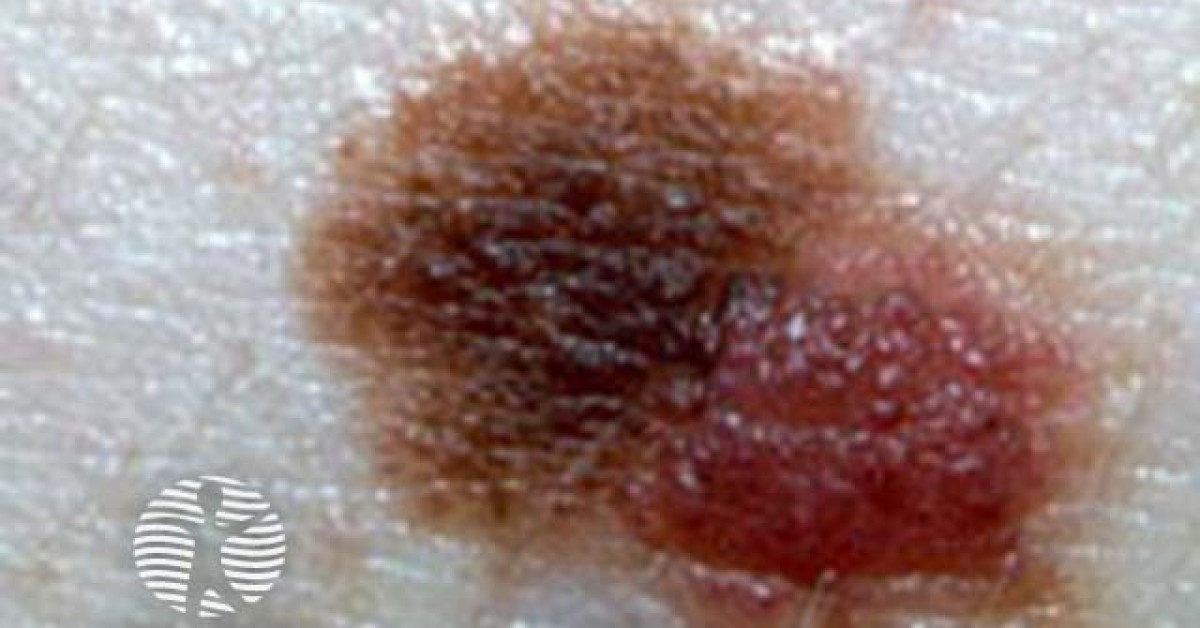 Combined naevus clinical image