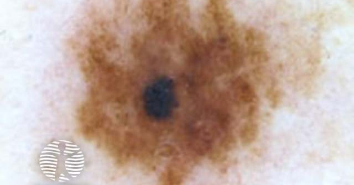 Combined naevus dermoscopy image