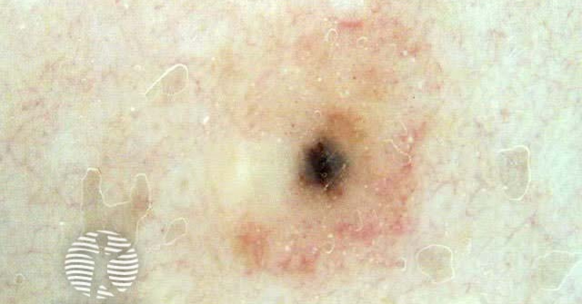 Combined naevus image