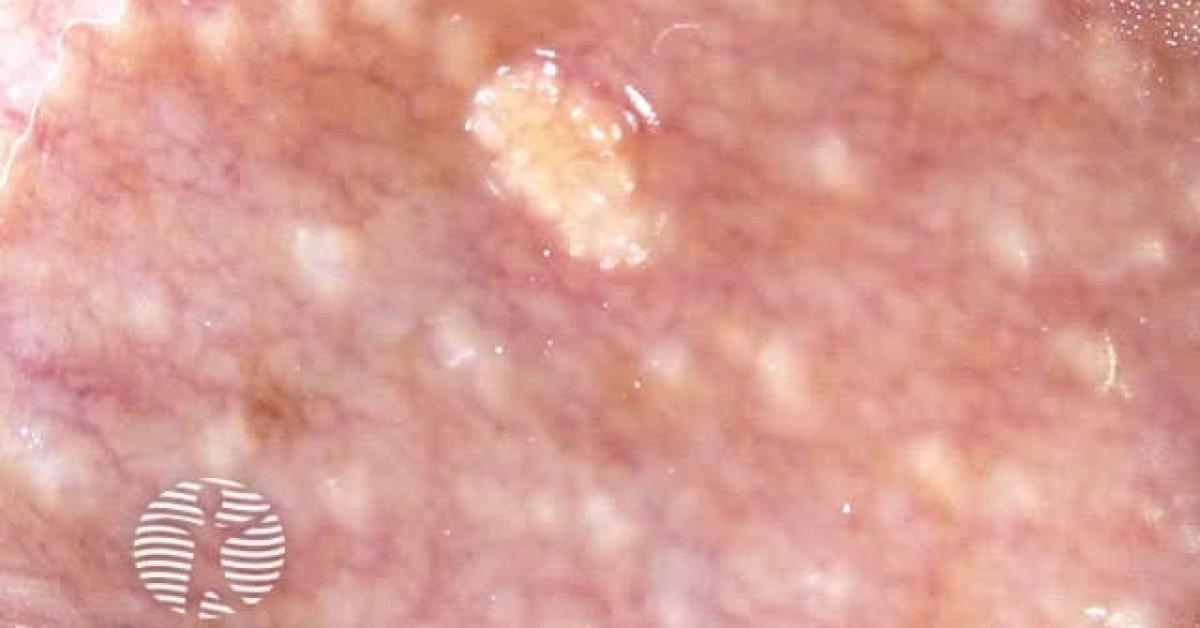 Sebaceous hyperplasia image