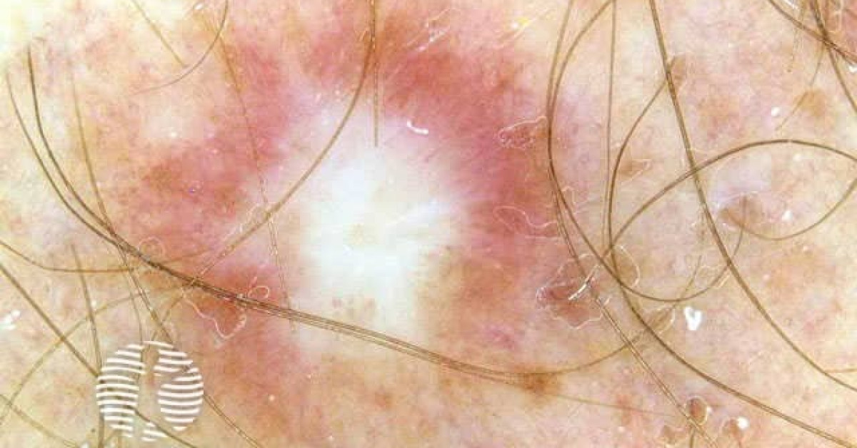 Dermatofibroma image