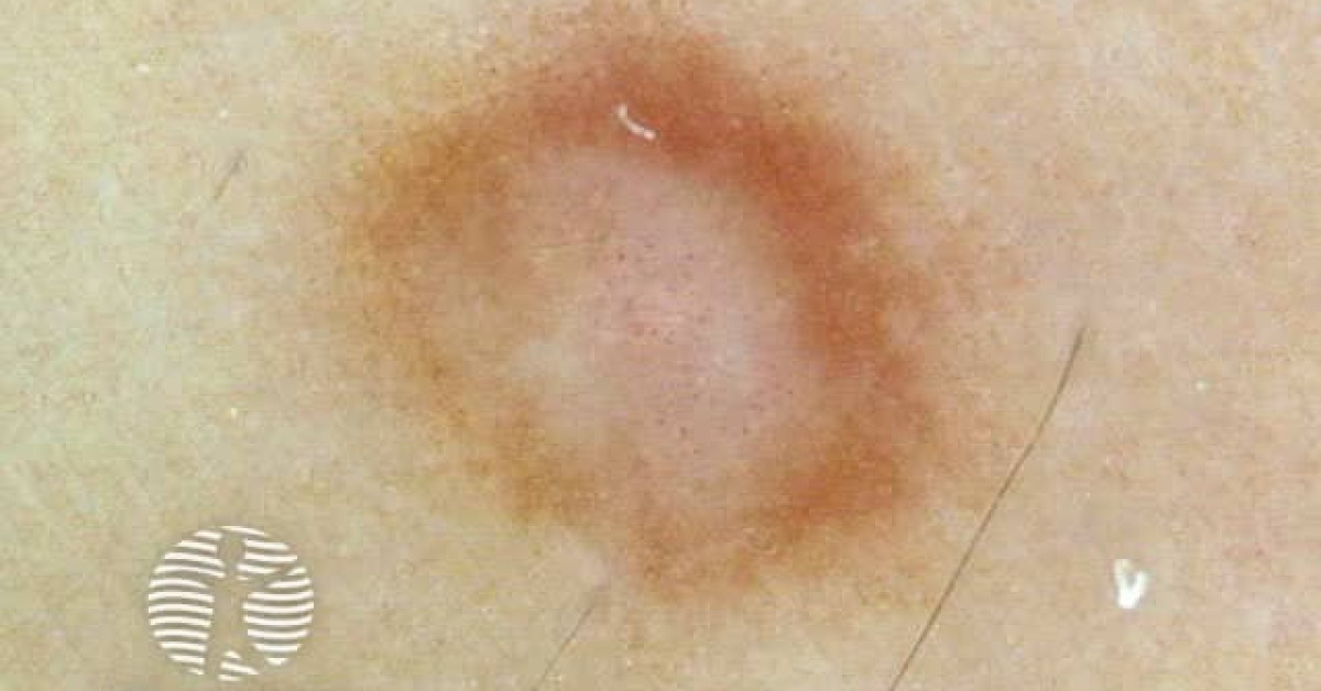 Dermatofibroma image