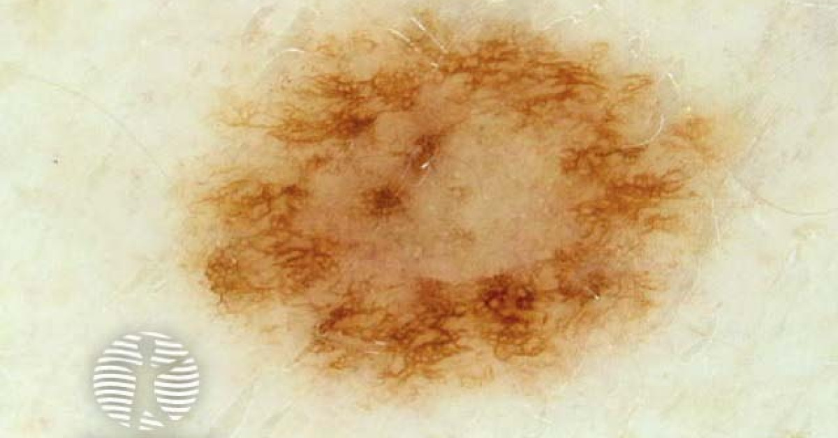 Melanocytic naevus image