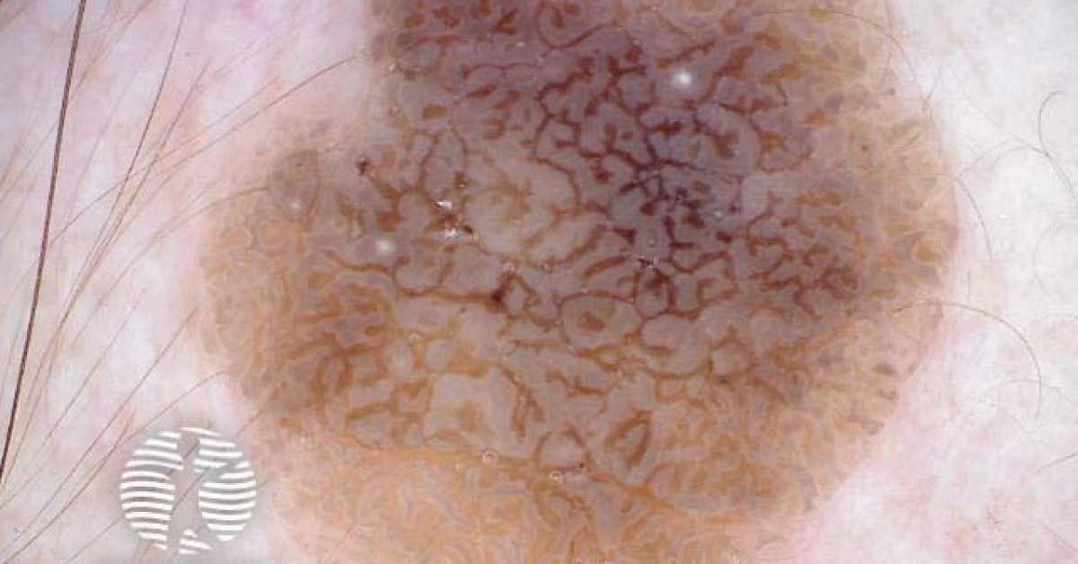 Seborrhoeic keratosis dermoscopy image