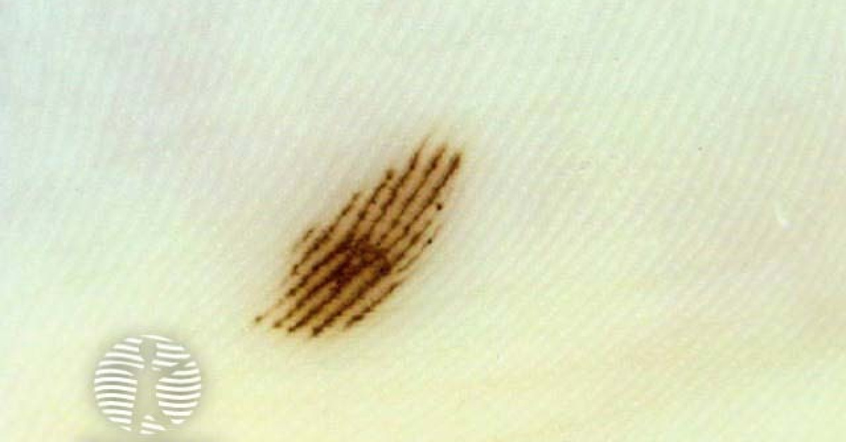 Dermoscopy. Parallel brown lines; acral naevus image