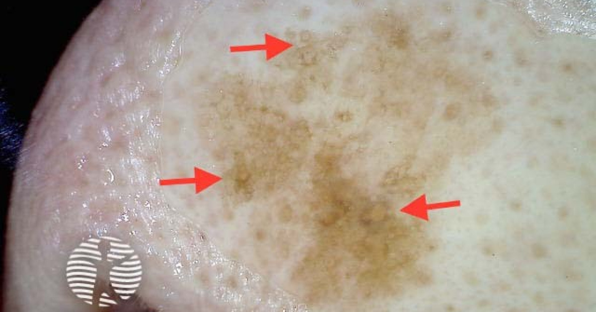 Dermoscopy. Brown and grey circles. Lentigo maligna image