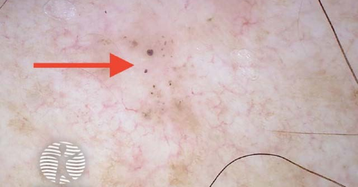 Dermoscopy. Grey dots (←). BCC image