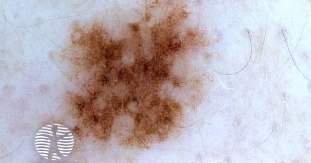 Dermoscopy. Reticular pattern image