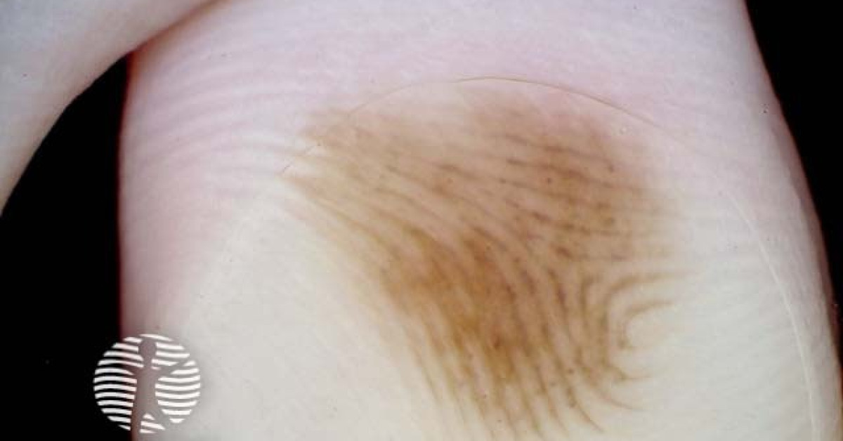 Dermoscopy. Parallel pattern image