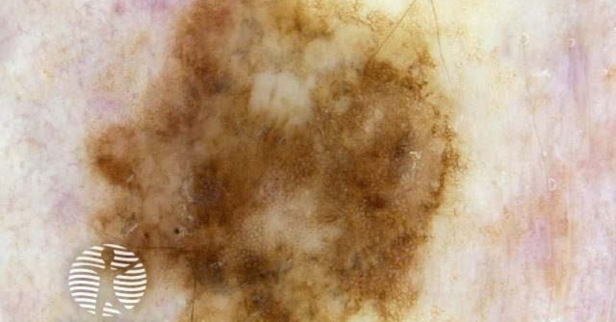 Dermoscopy. Mixed pattern, mainly lines. Melanoma image