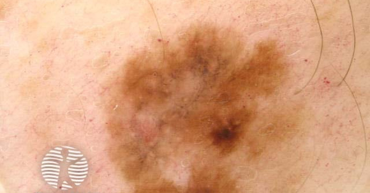 Dermoscopy. Mixed pattern; melanoma image