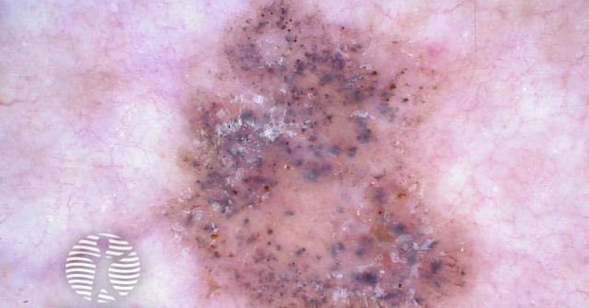Dermoscopy. Brown and blue-grey dots/clods. BCC image