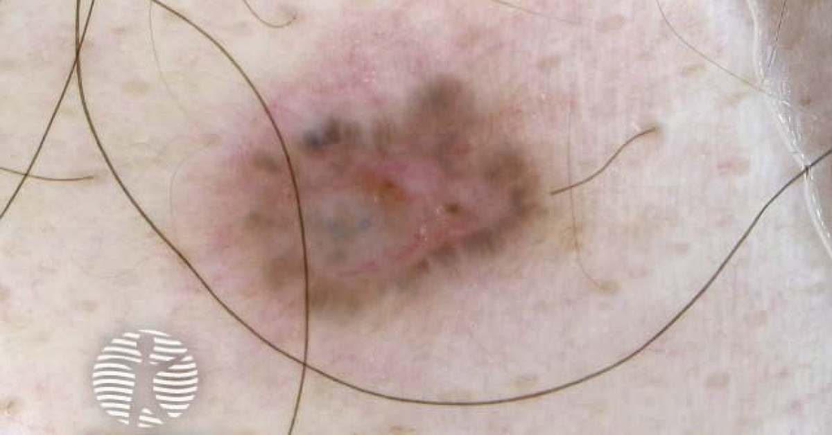 Dermoscopy. Segmental peripheral radial lines. BCC image