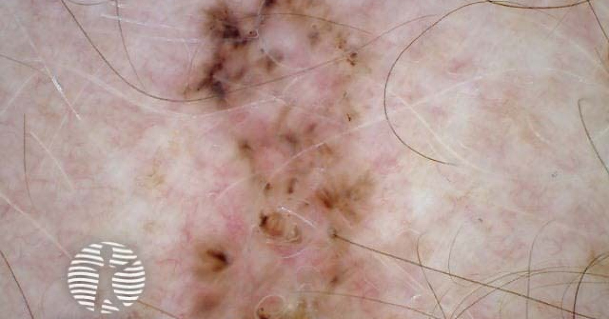 Dermoscopy. Radial lines around central dot. BCC image