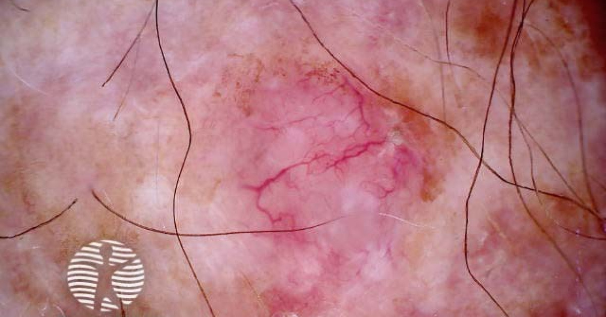 Dermoscopy. Branched red lines. BCC image