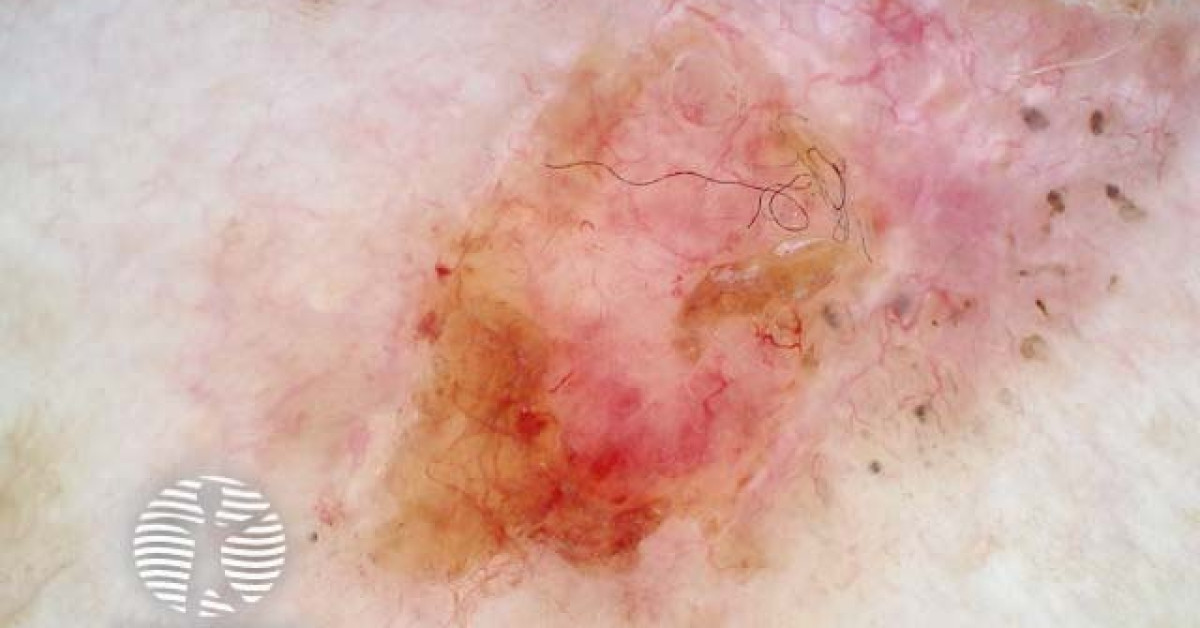 Dermoscopy. Yellow/red structureless zones image