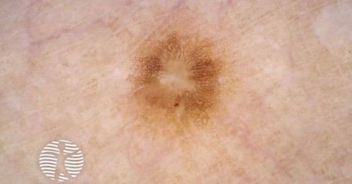 Dermoscopy. Peripheral network, central white area: dermatofibroma image