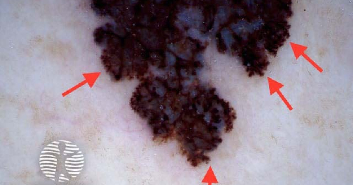 Dermoscopy. Chaos and clues image
