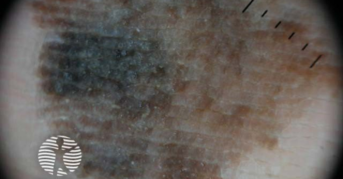 Dermoscopy. Chaos and clues image