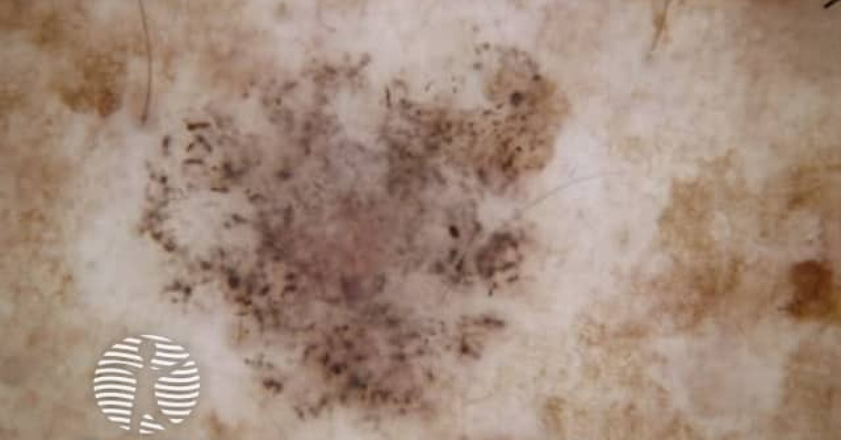 Lichen planus-like keratosis: dermatoscopy image