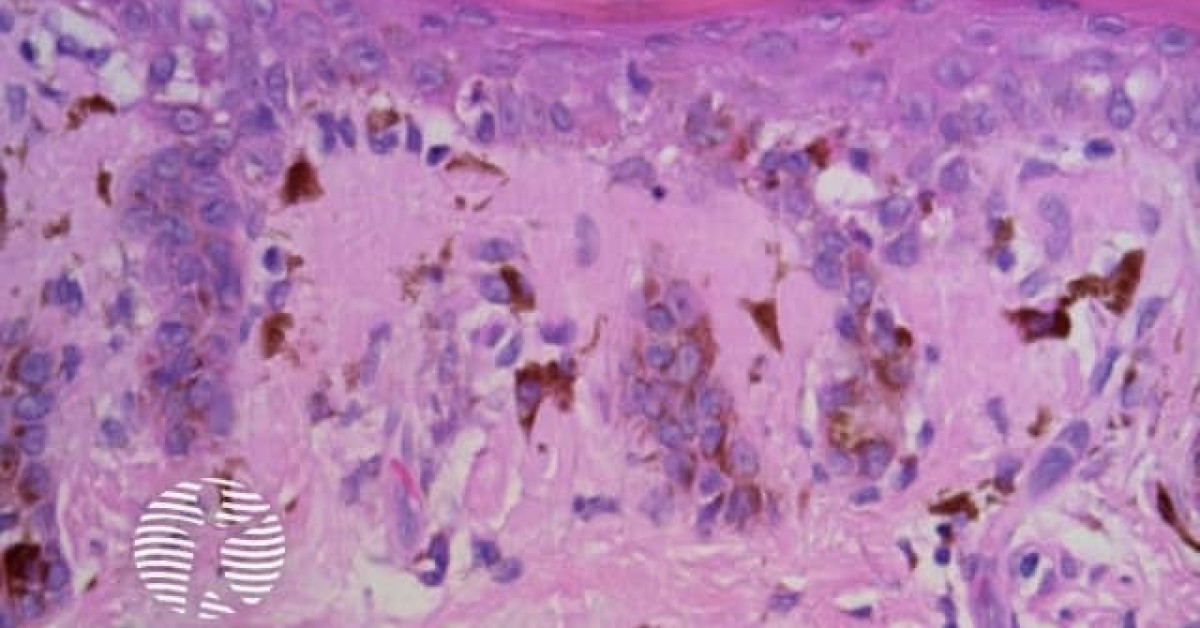 DermNet® - Lichen planus-like keratosis: dermatoscopy image