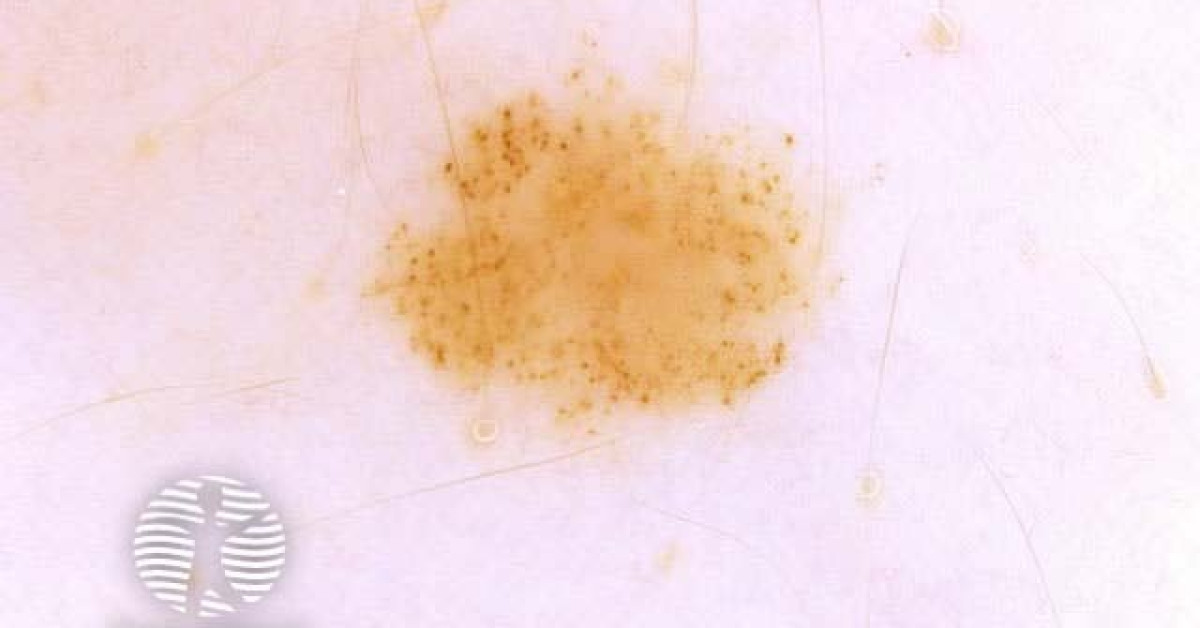 Melanocytic naevus image