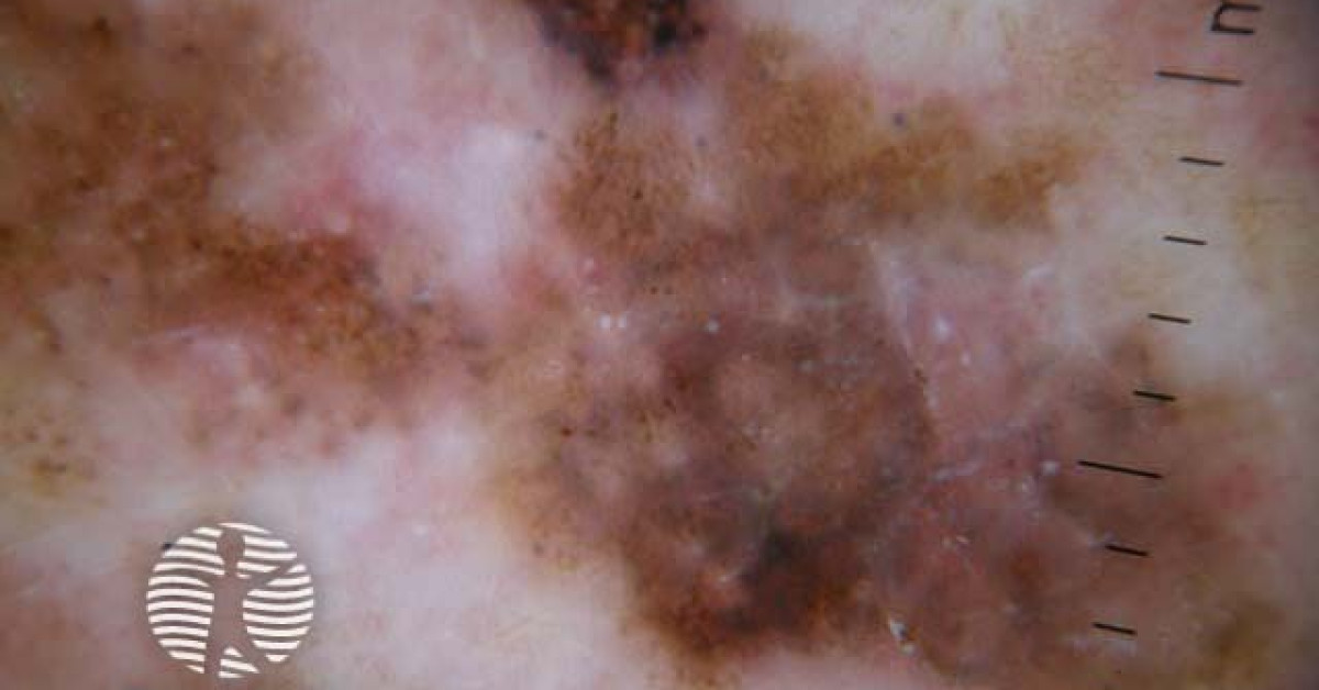 CHAOS and clues in melanoma image