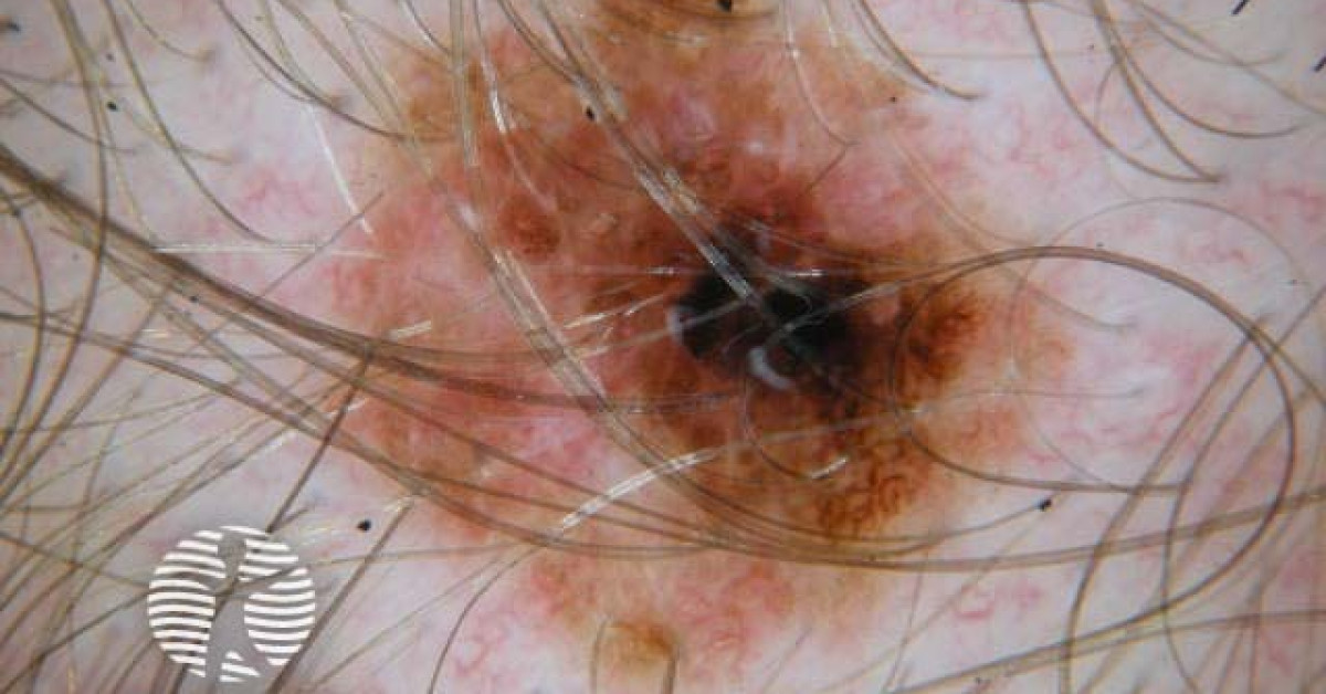 CHAOS and clues in melanoma image