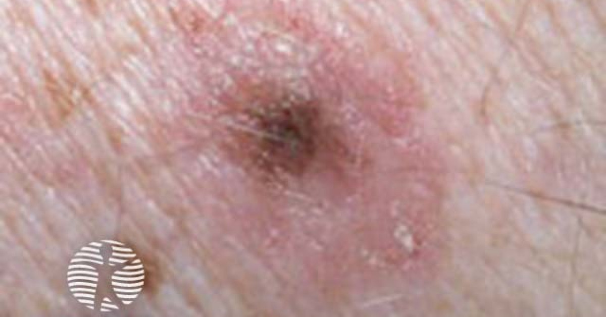 Meyerson naevus clinical image