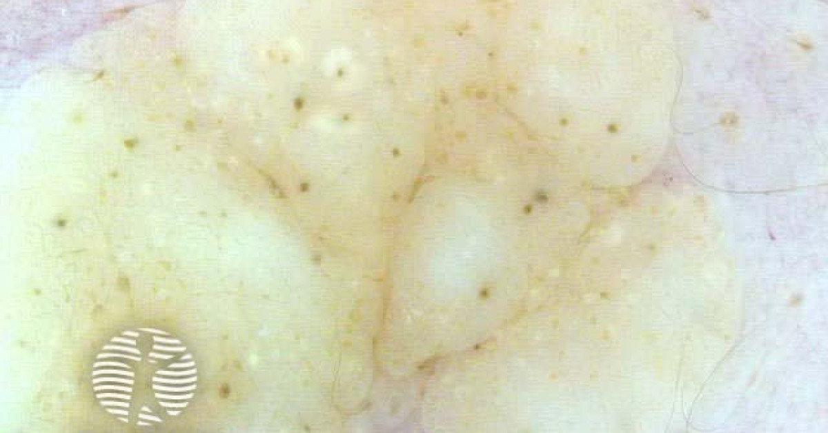 Epidermal naevus image