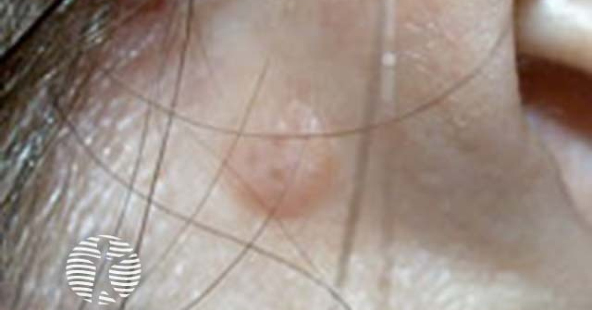 Facial naevus clinical image