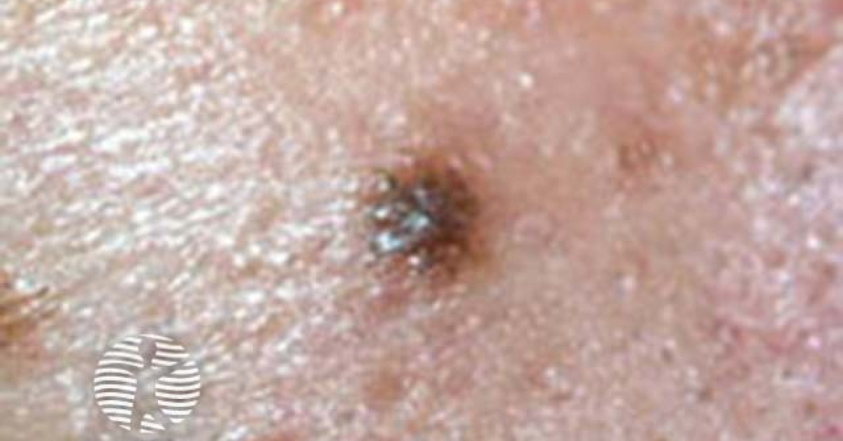 Facial naevus clinical image