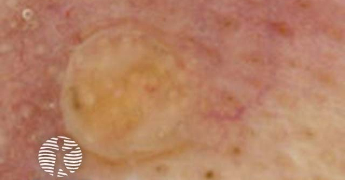 facial naevus dermoscopy image