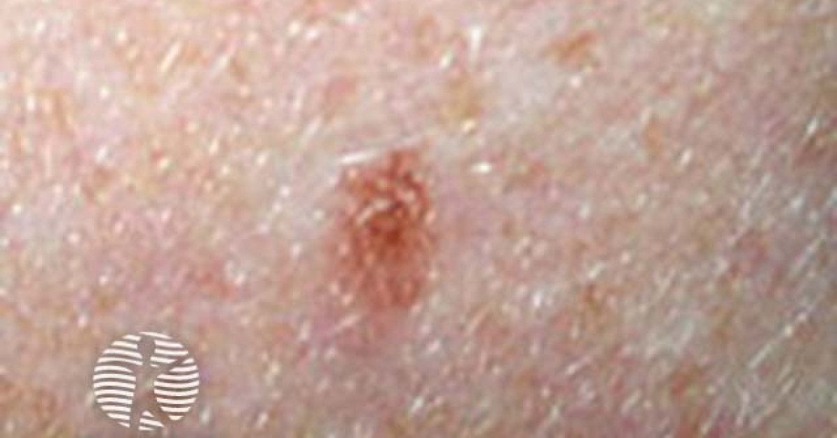 facial naevus clinical image