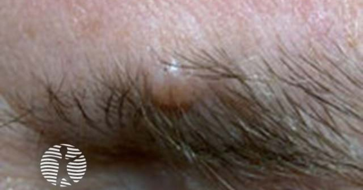 facial naevus clinical image