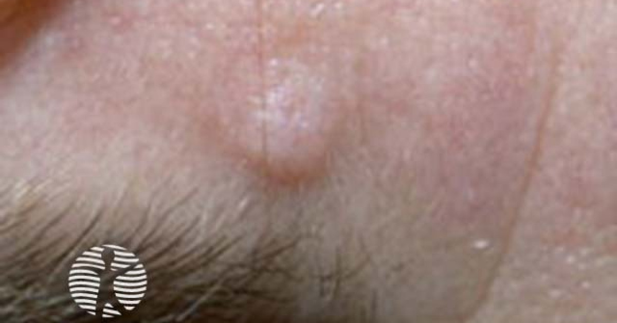 facial naevus clinical image