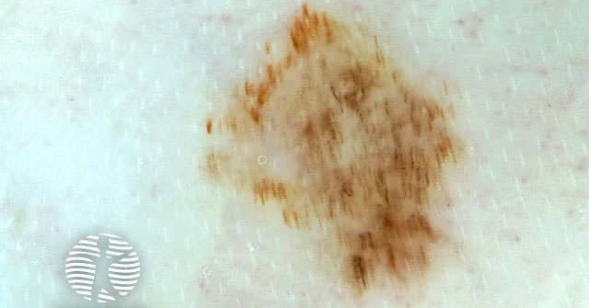 DermNet® - Fibrillar pattern image