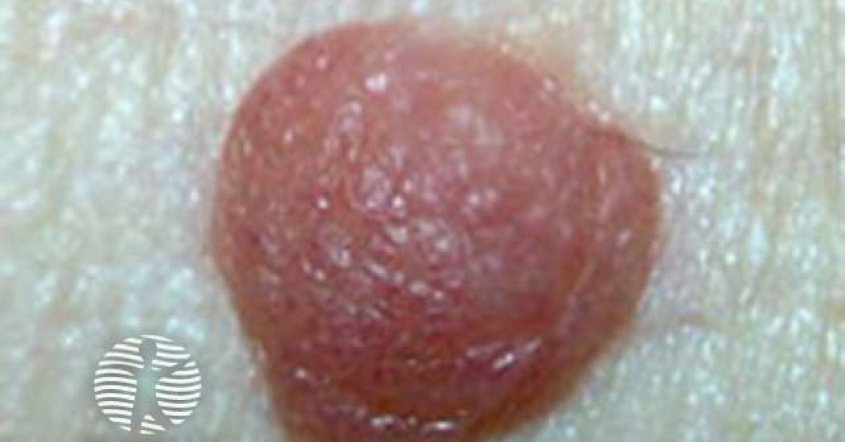 Globular pattern clinical image