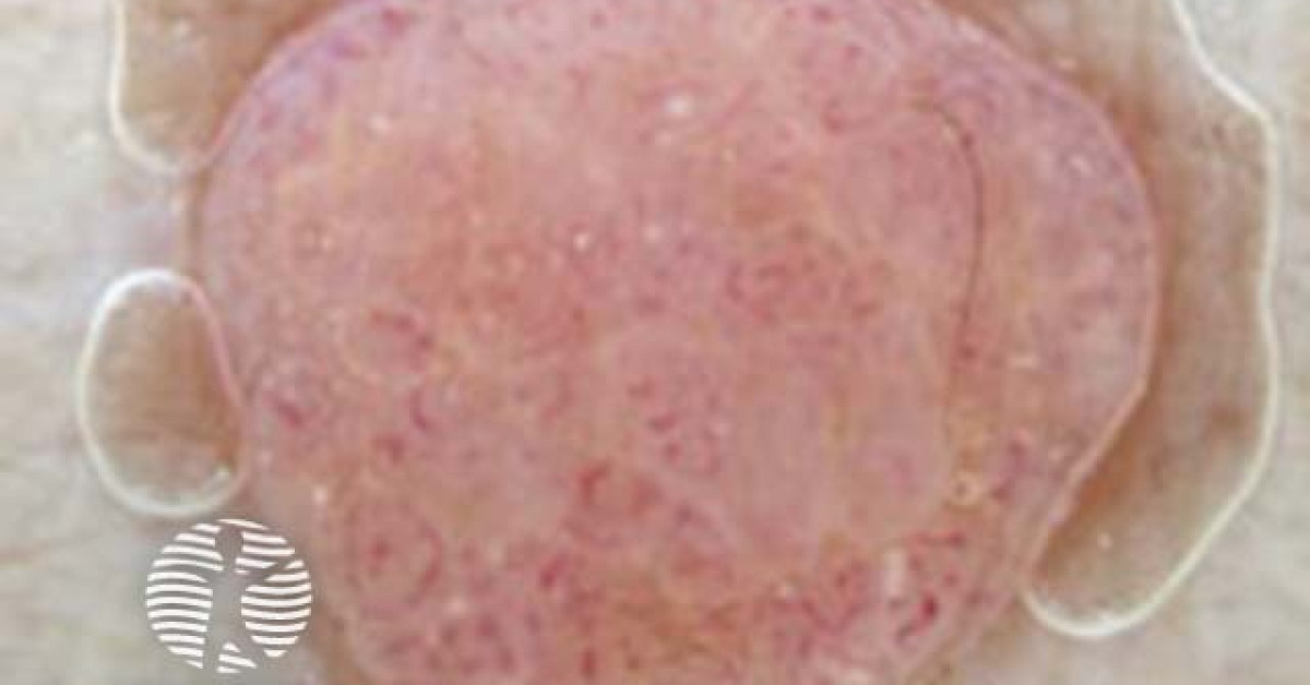 Globular pattern dermoscopy image