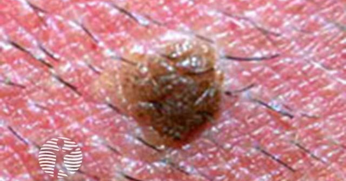 Globular pattern clinical image