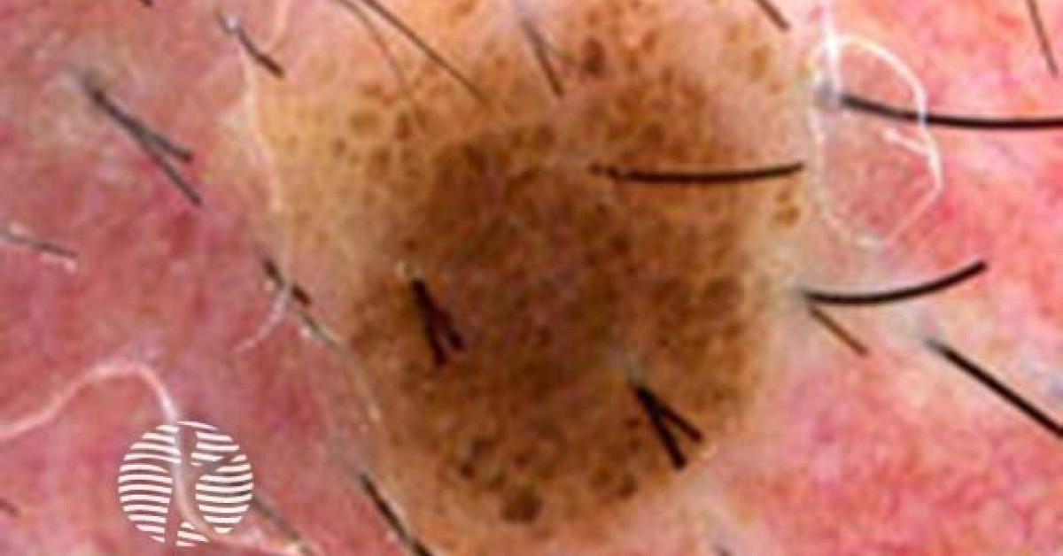 Globular pattern dermoscopy image