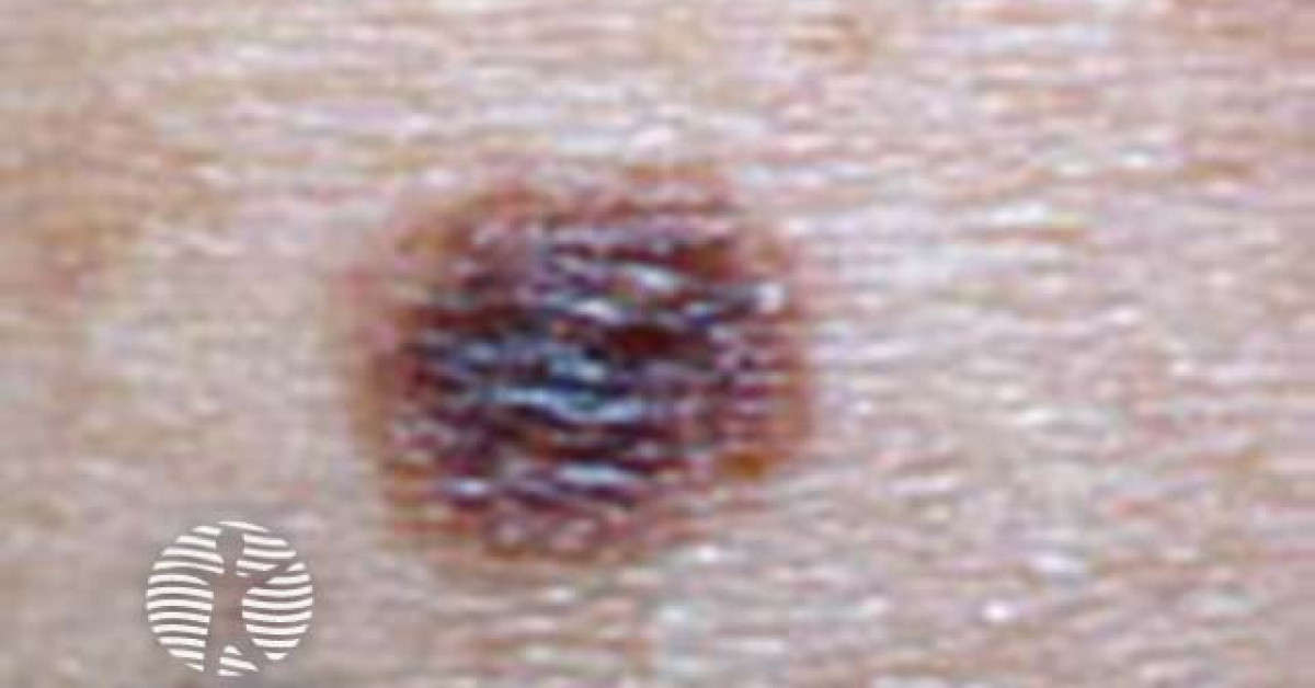 Globular pattern clinical image