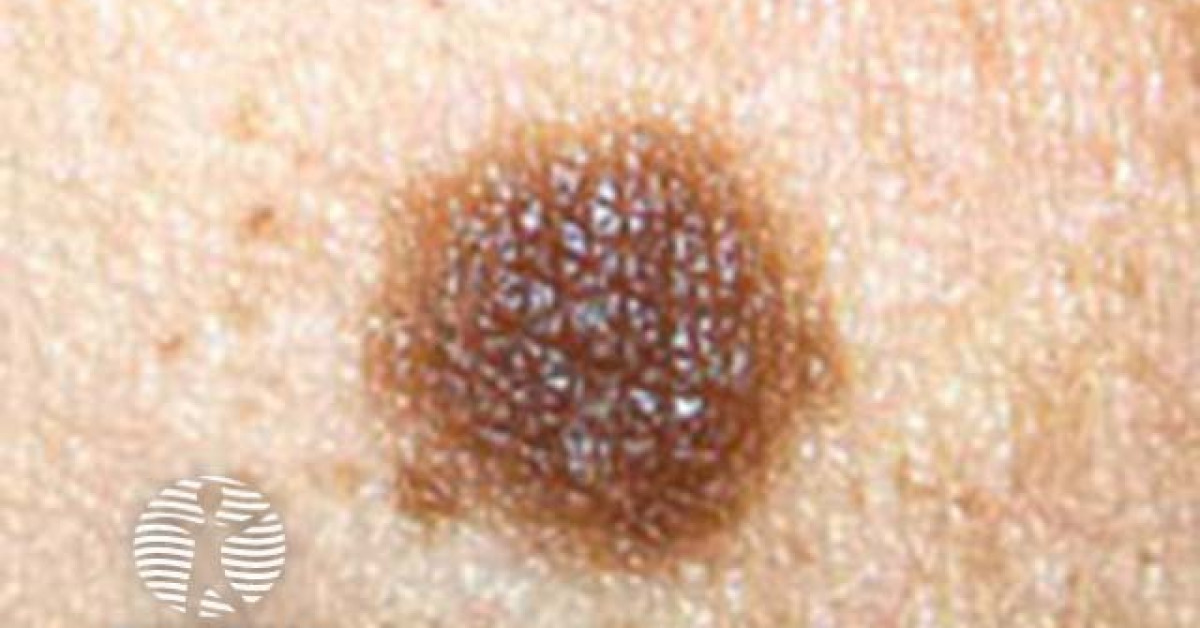 Globular pattern clinical image