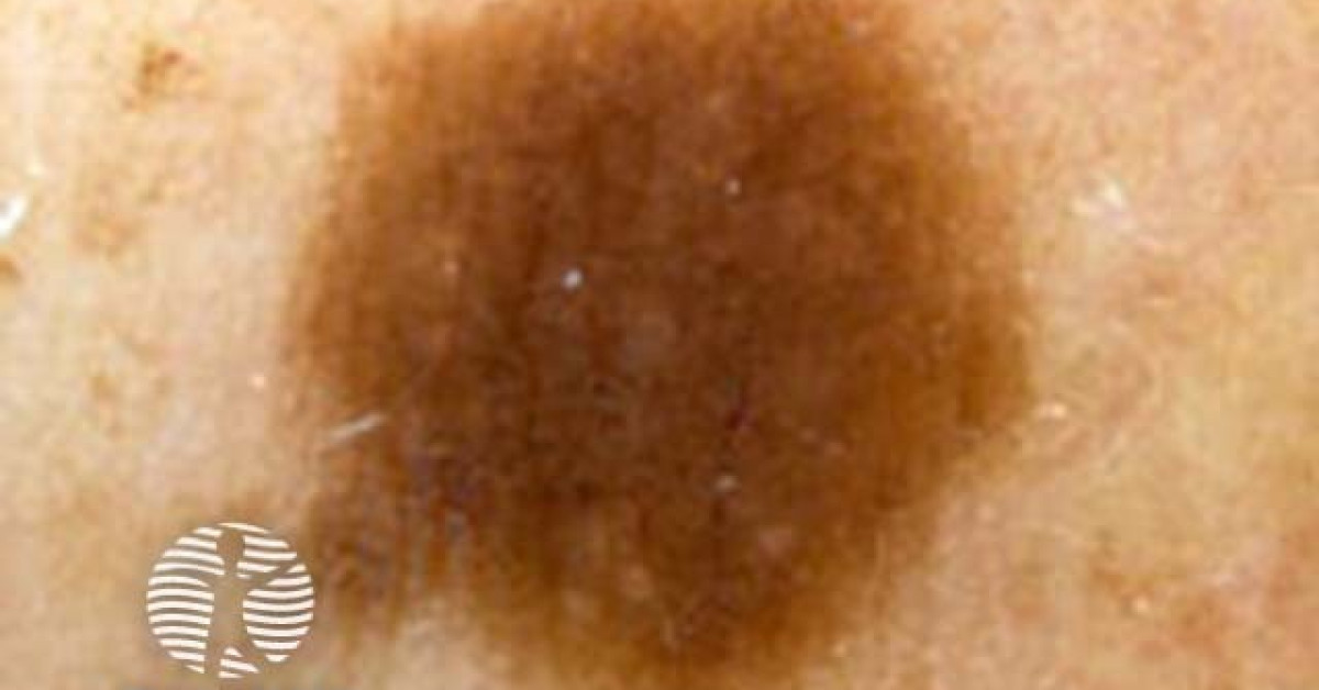 Globular pattern dermoscopy image