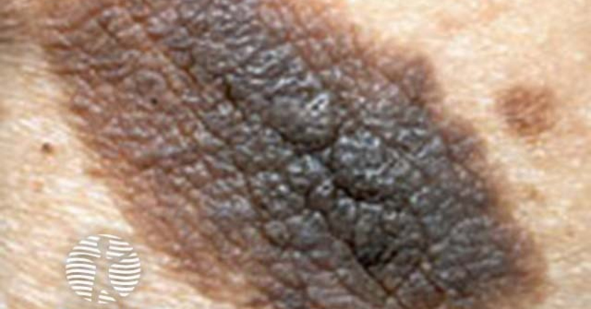 Globular Pattern Clinical Image