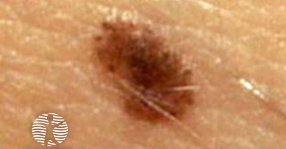 Globular pattern clinical image