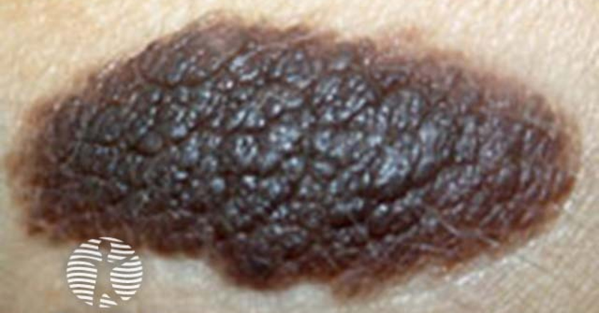 Globular pattern clinical image
