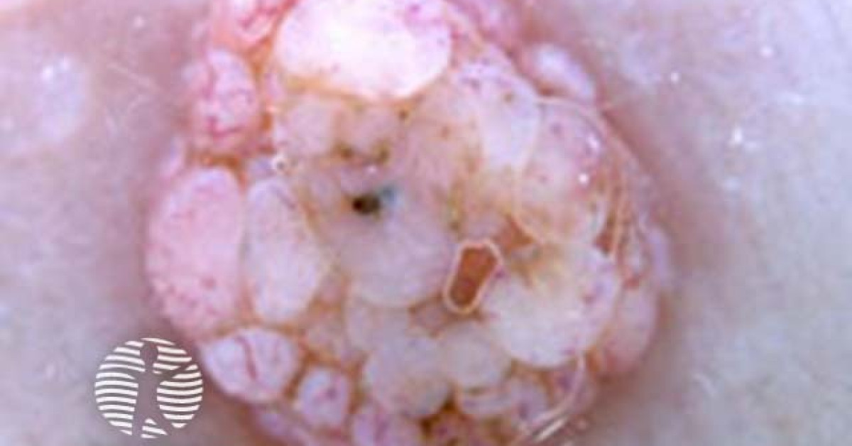 Globular pattern dermoscopy image