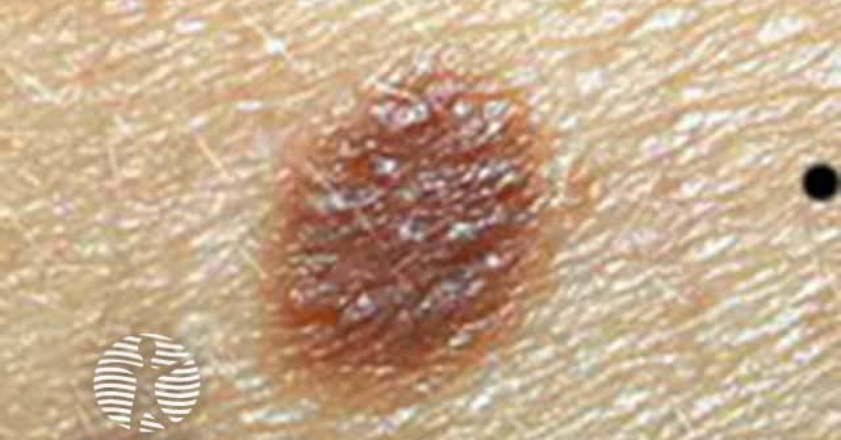 Globular pattern clinical image