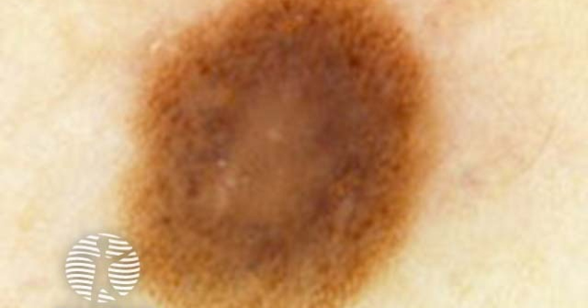 Globular pattern dermoscopy image